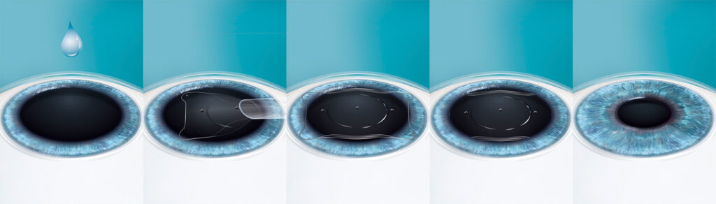 EVO ICL in Wilmington, NC | ICL Eye Surgery